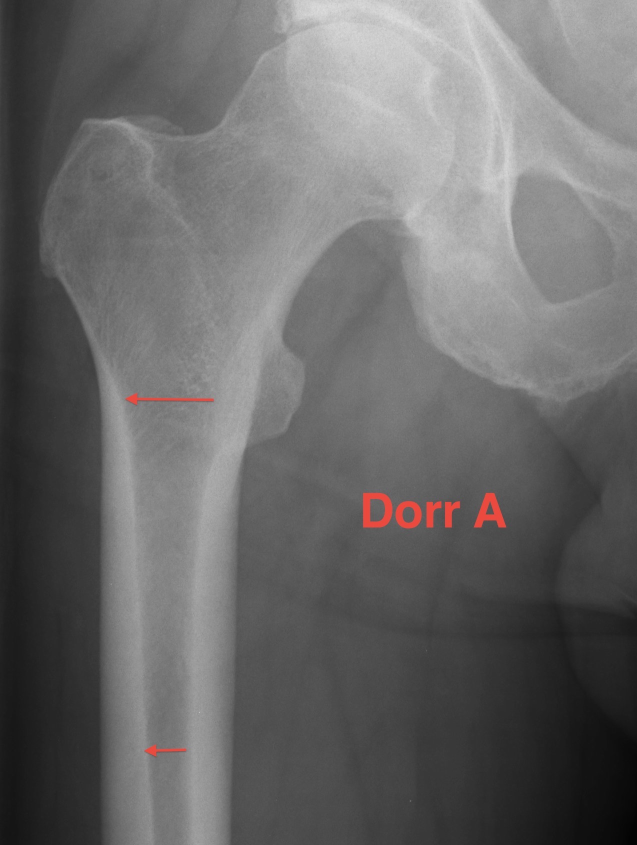 Uncemented femur | The Bone School