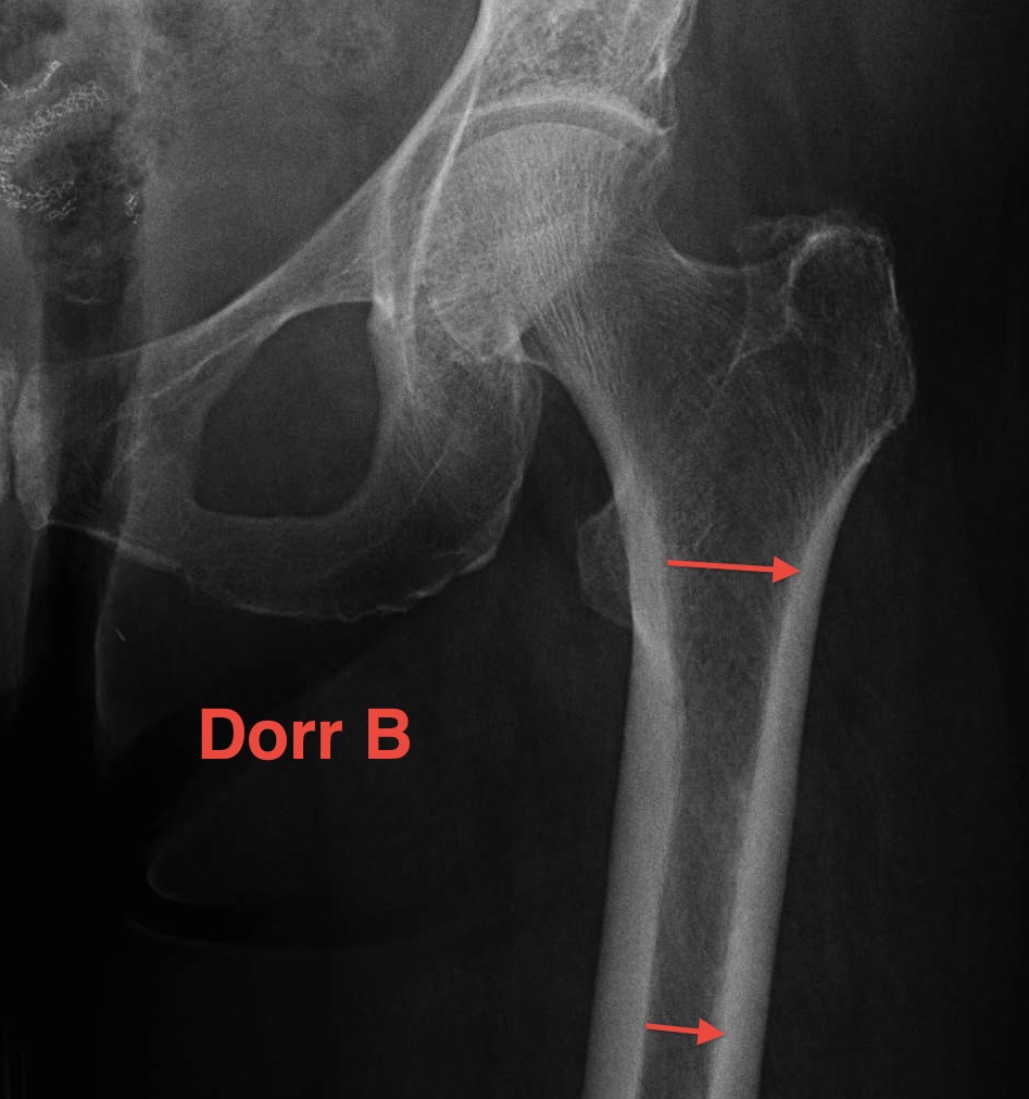Uncemented femur | The Bone School