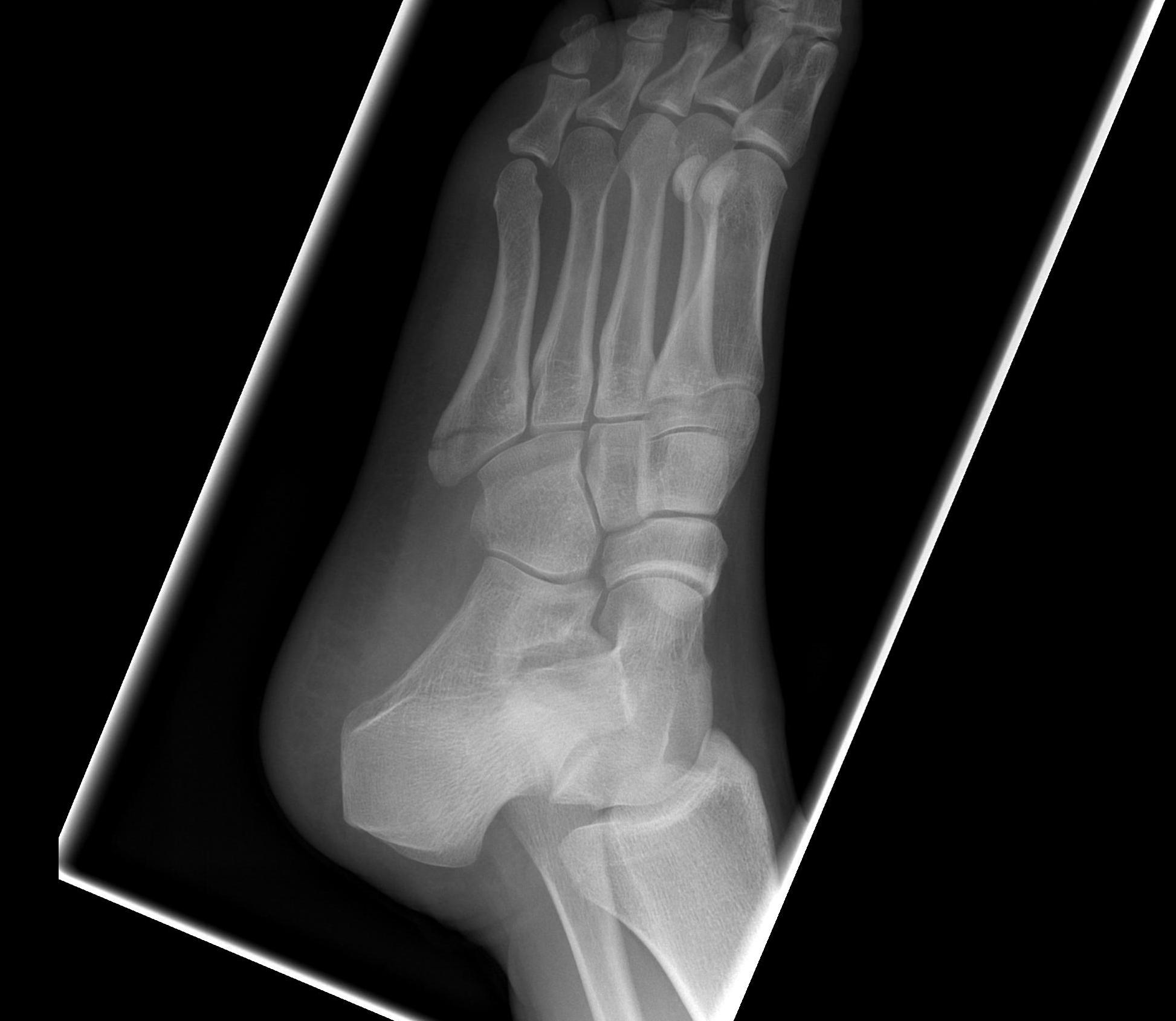 Distal 5th Metatarsal Fracture
