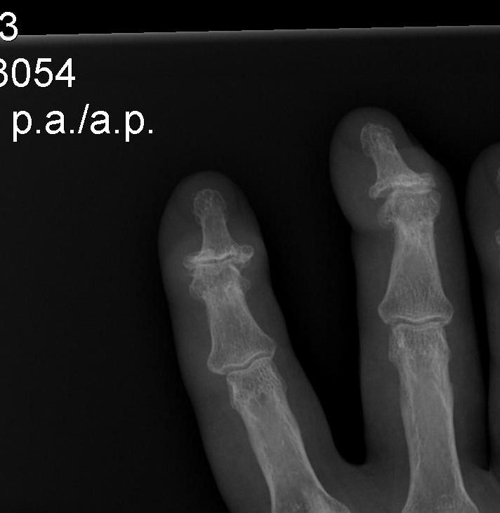 Osteoarthritis | The Bone School