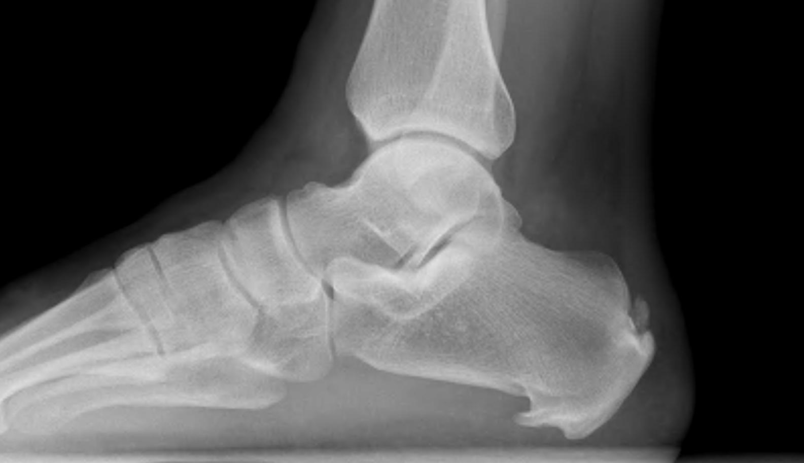 Plantar Fasciitis | The Bone School