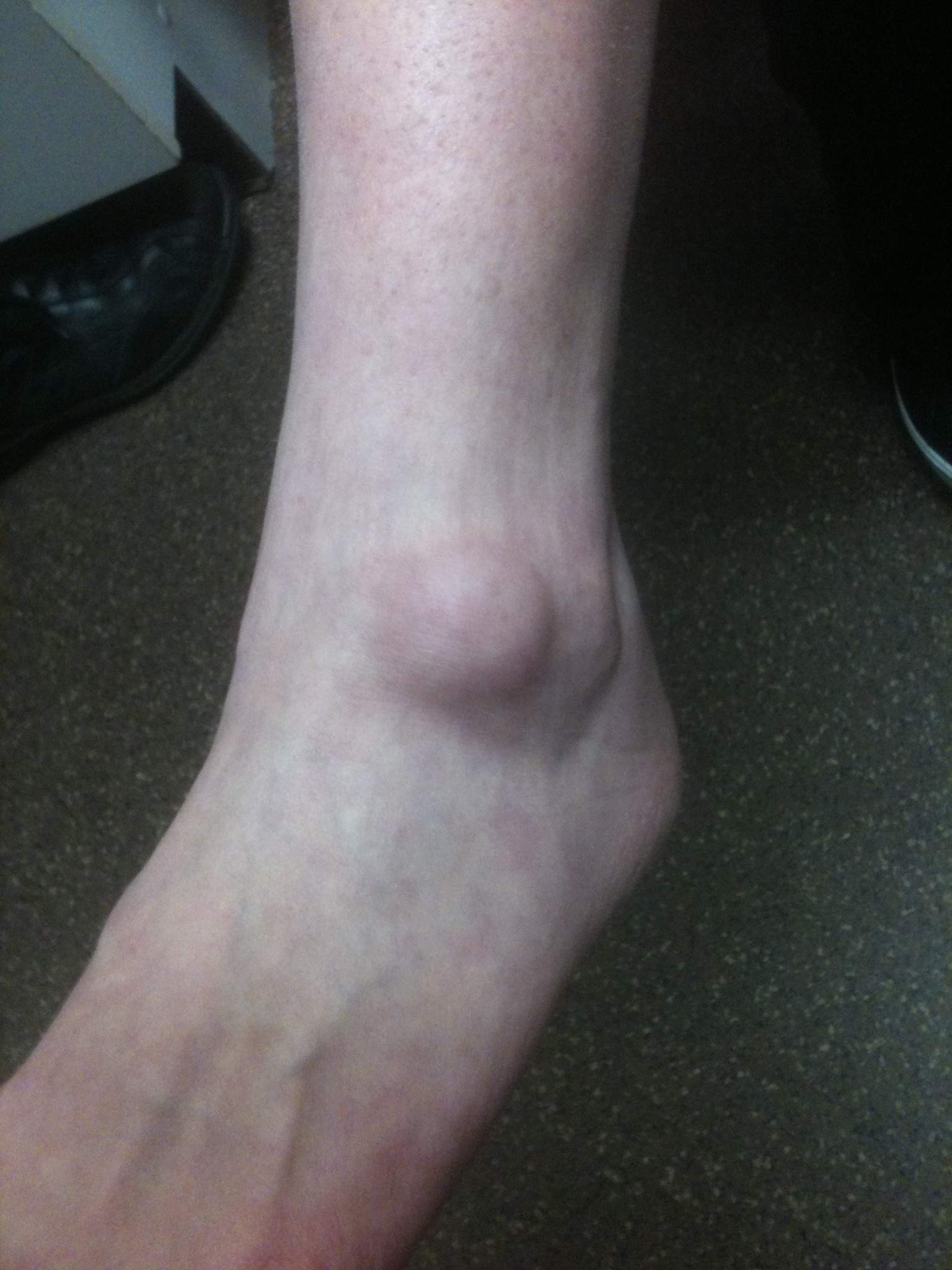 Benign Soft Tissue Tumours | The Bone School