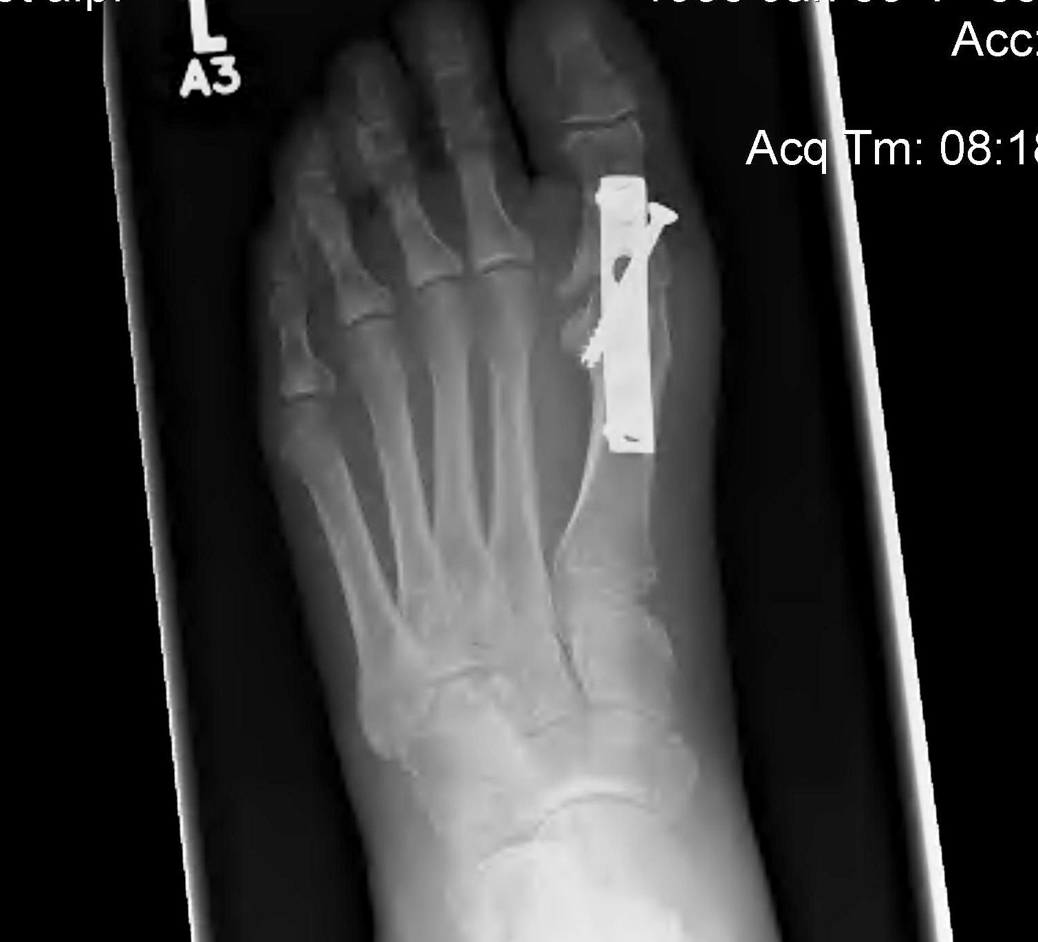 Hallux Rigidus | The Bone School