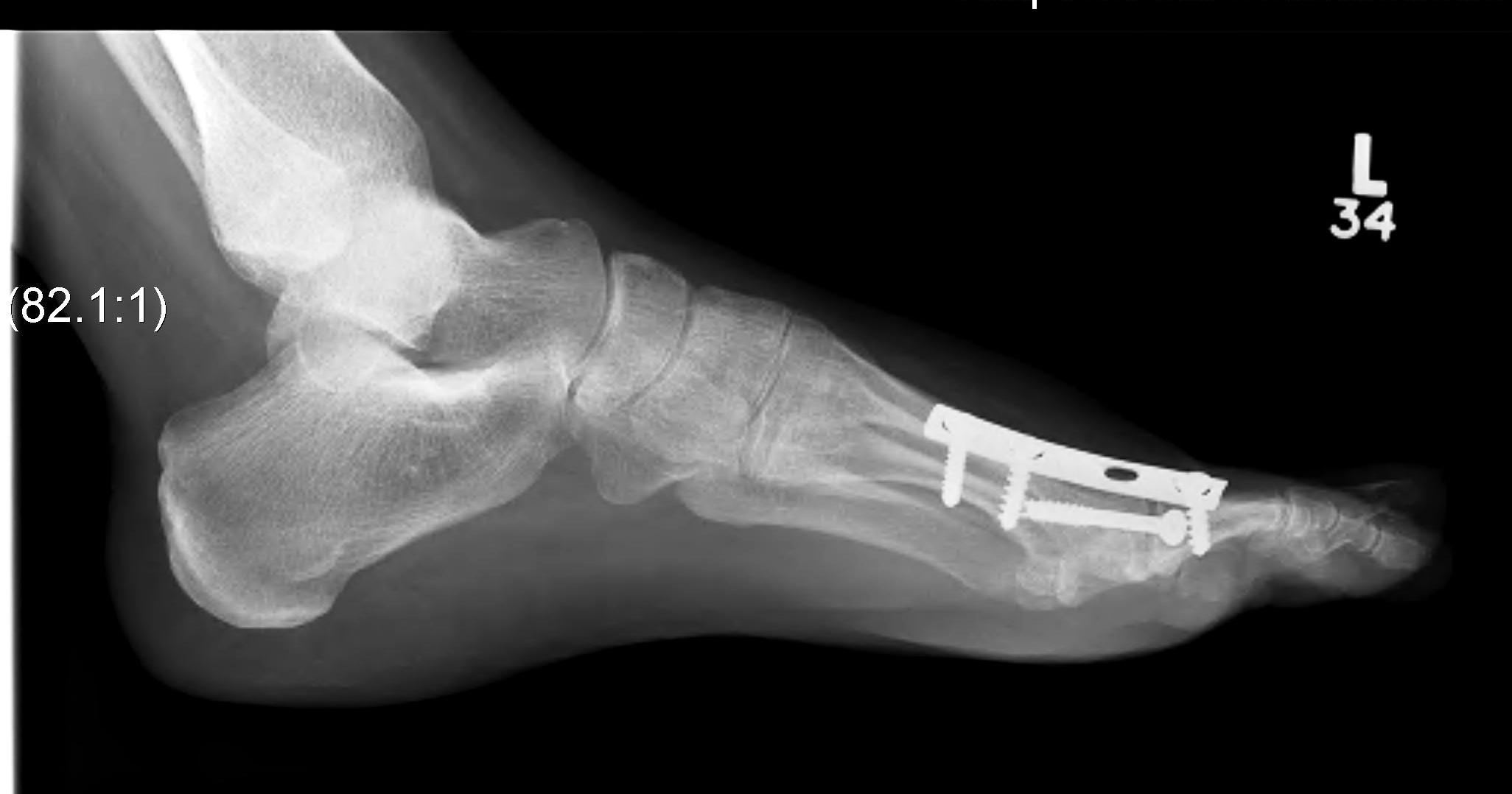 Hallux Rigidus Arthrodesis