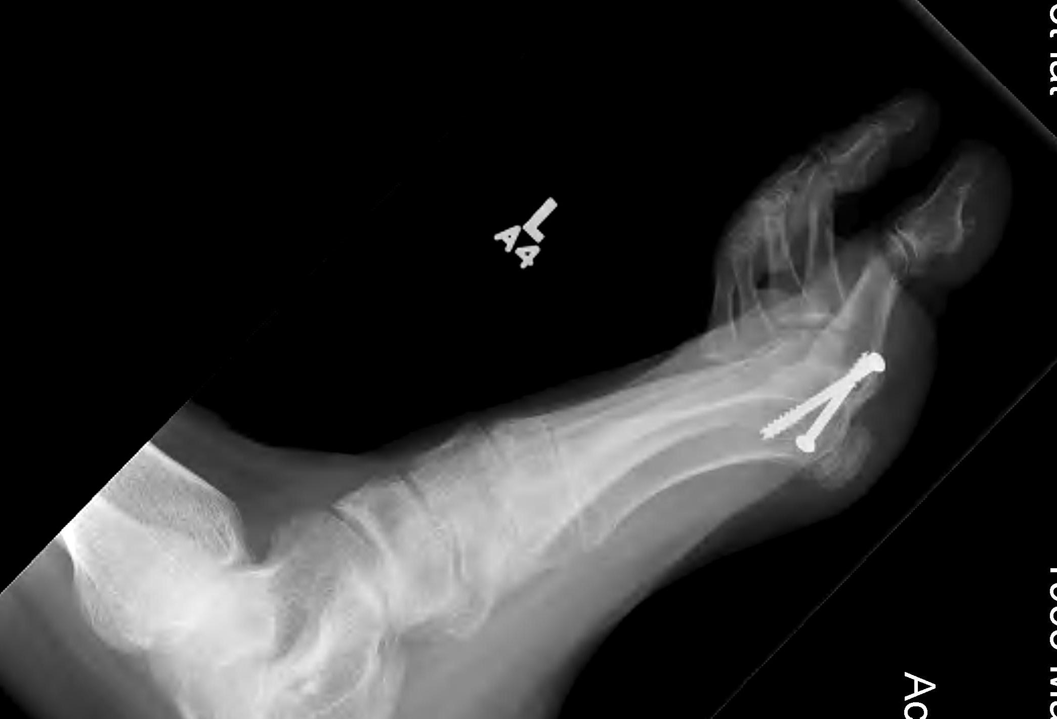 Hallux Rigidus | The Bone School