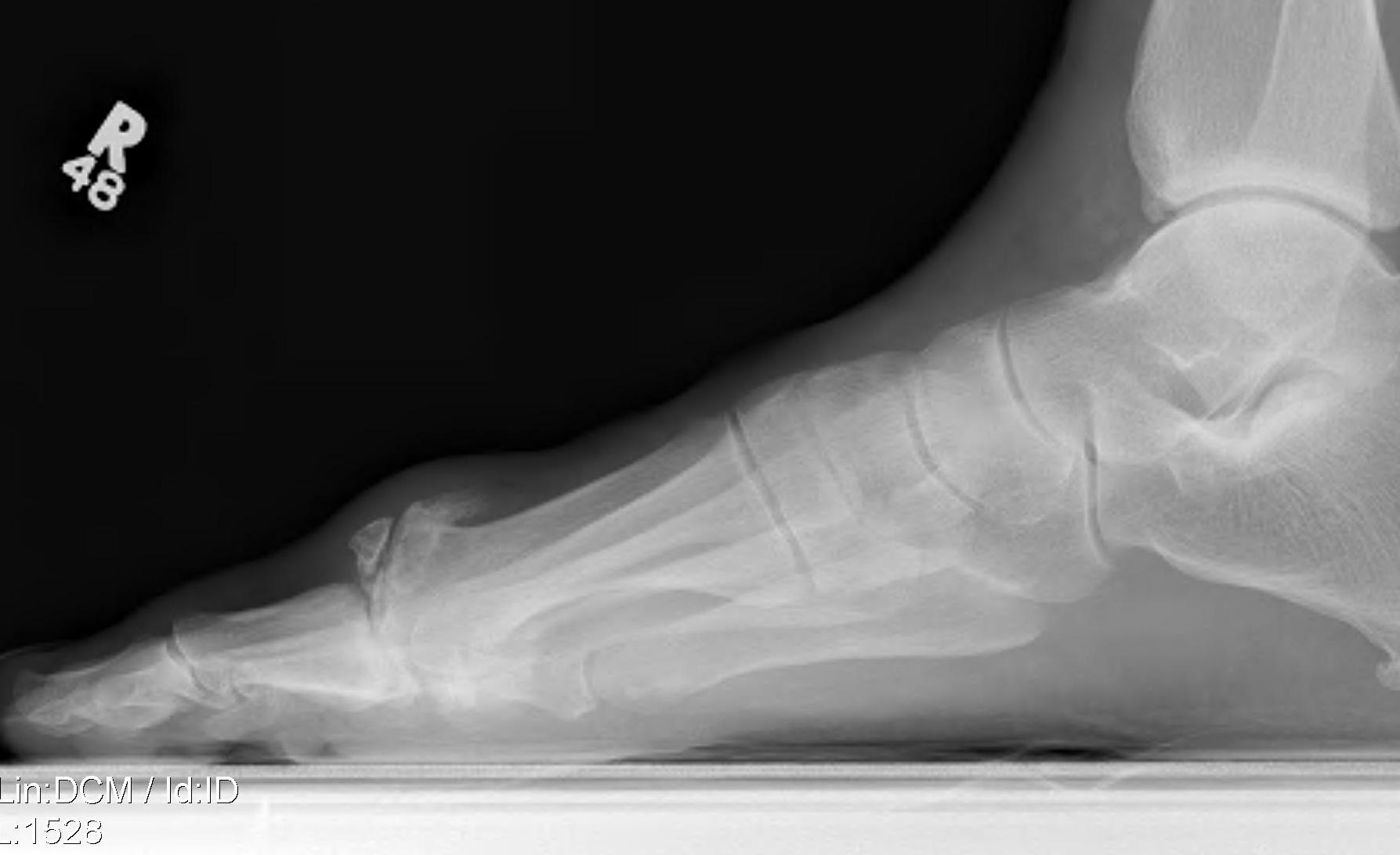 Hallux Rigidus X Ray
