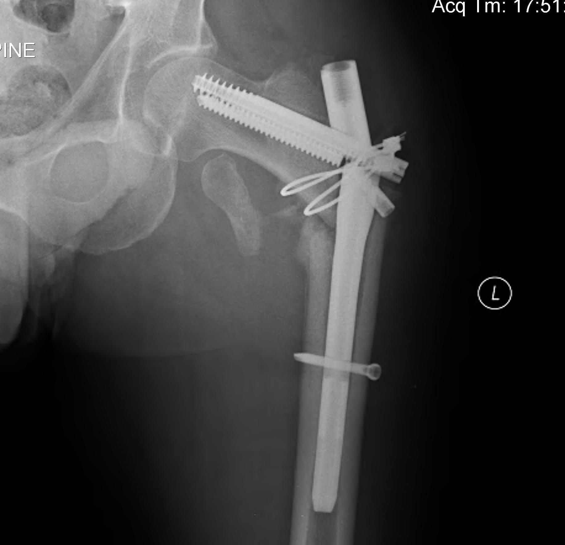 Subtrochanteric Fractures | The Bone School