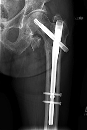 Intertrochanteric Fractures | The Bone School