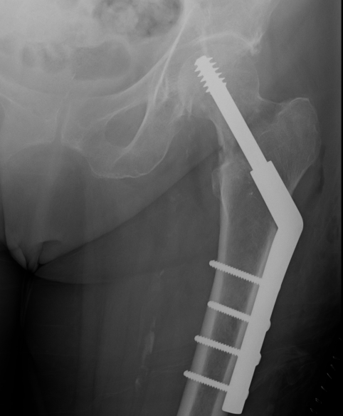 Intertrochanteric Fractures | The Bone School