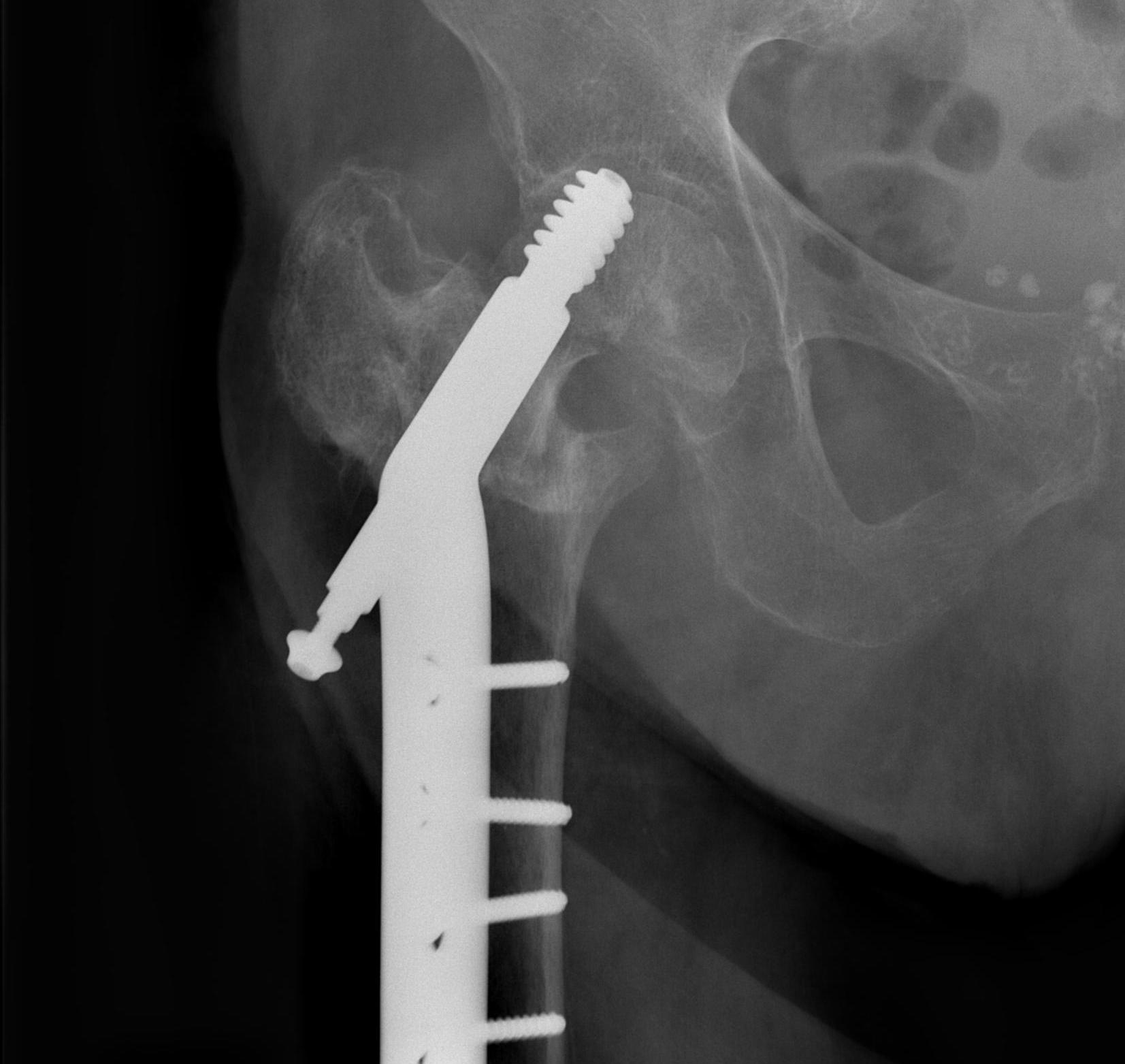 Intertrochanteric Fracture Dhs