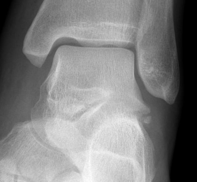 Talar Body Fracture | The Bone School