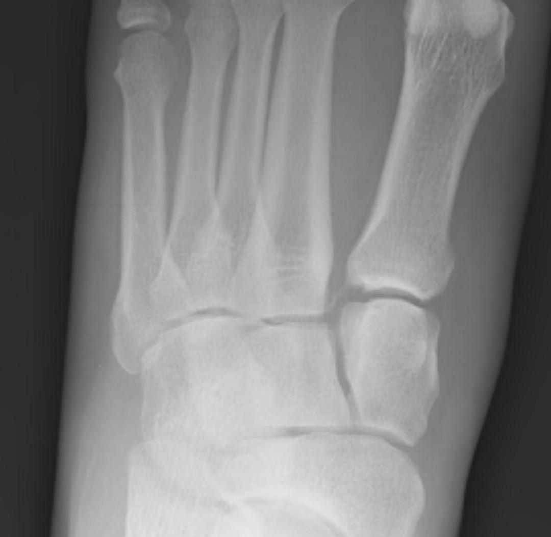 Lis Franc | The Bone School