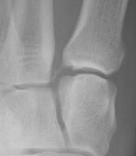 Lis Franc | The Bone School