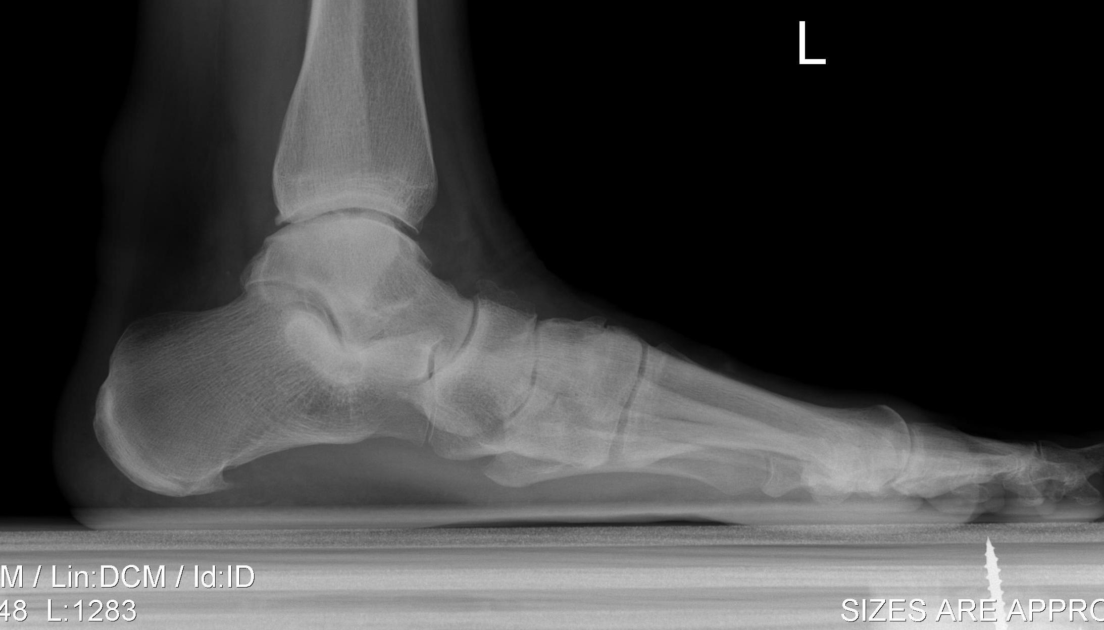 Aquired Adult Flatfoot Deformity | The Bone School