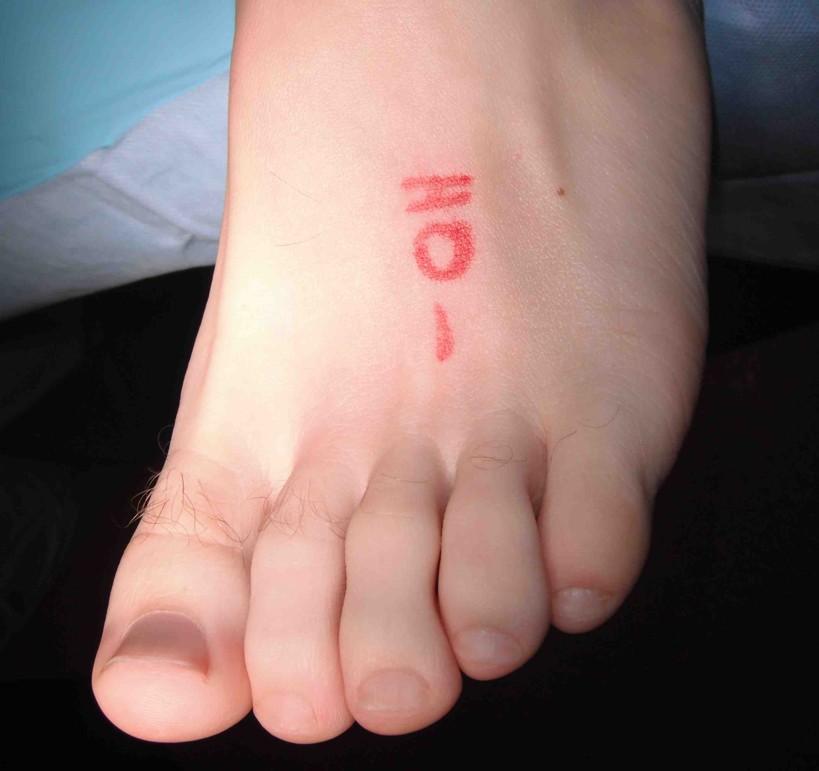 Morton's Neuroma | The Bone School