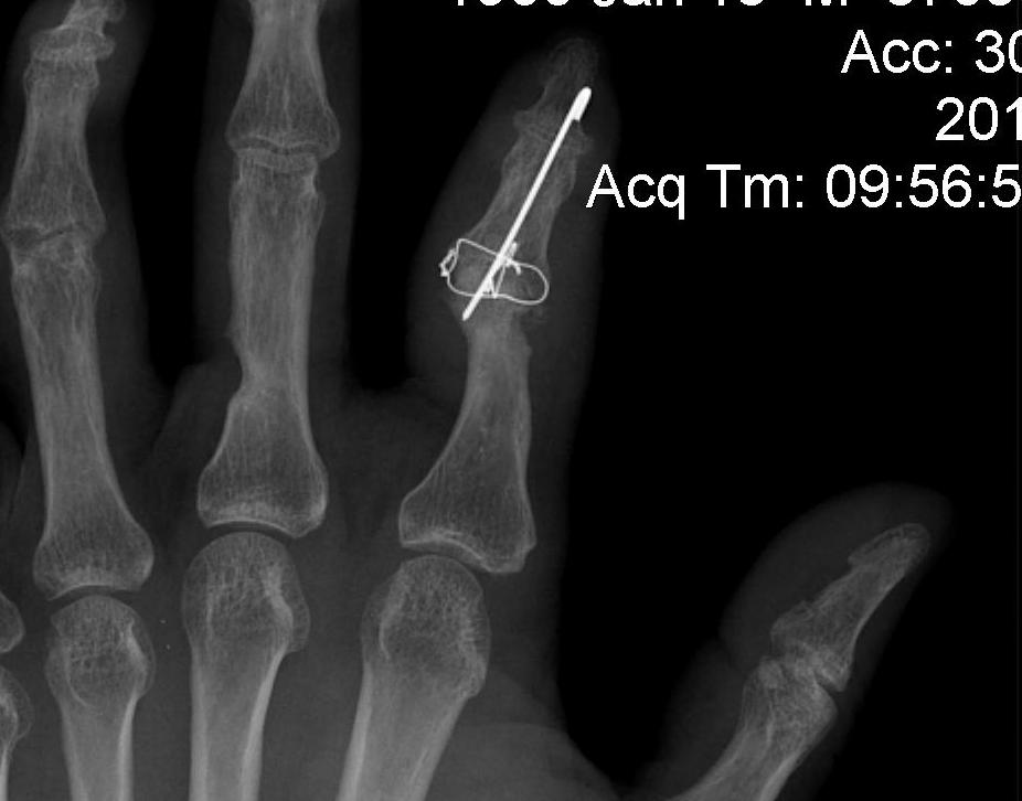 Osteoarthritis | The Bone School
