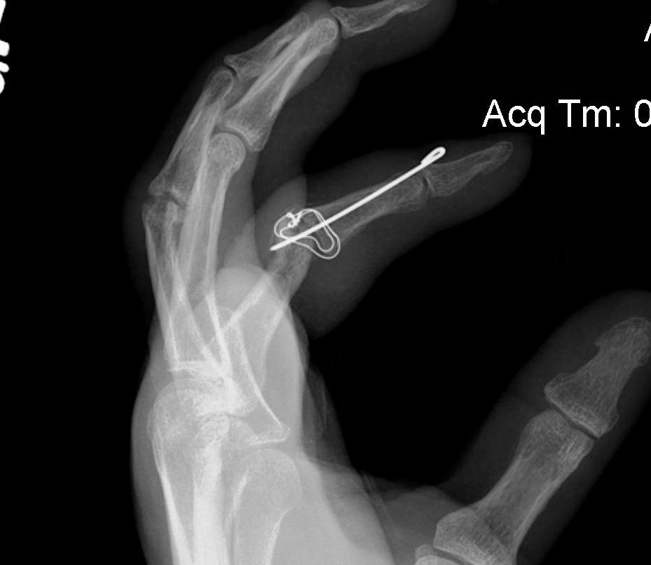 Osteoarthritis | The Bone School