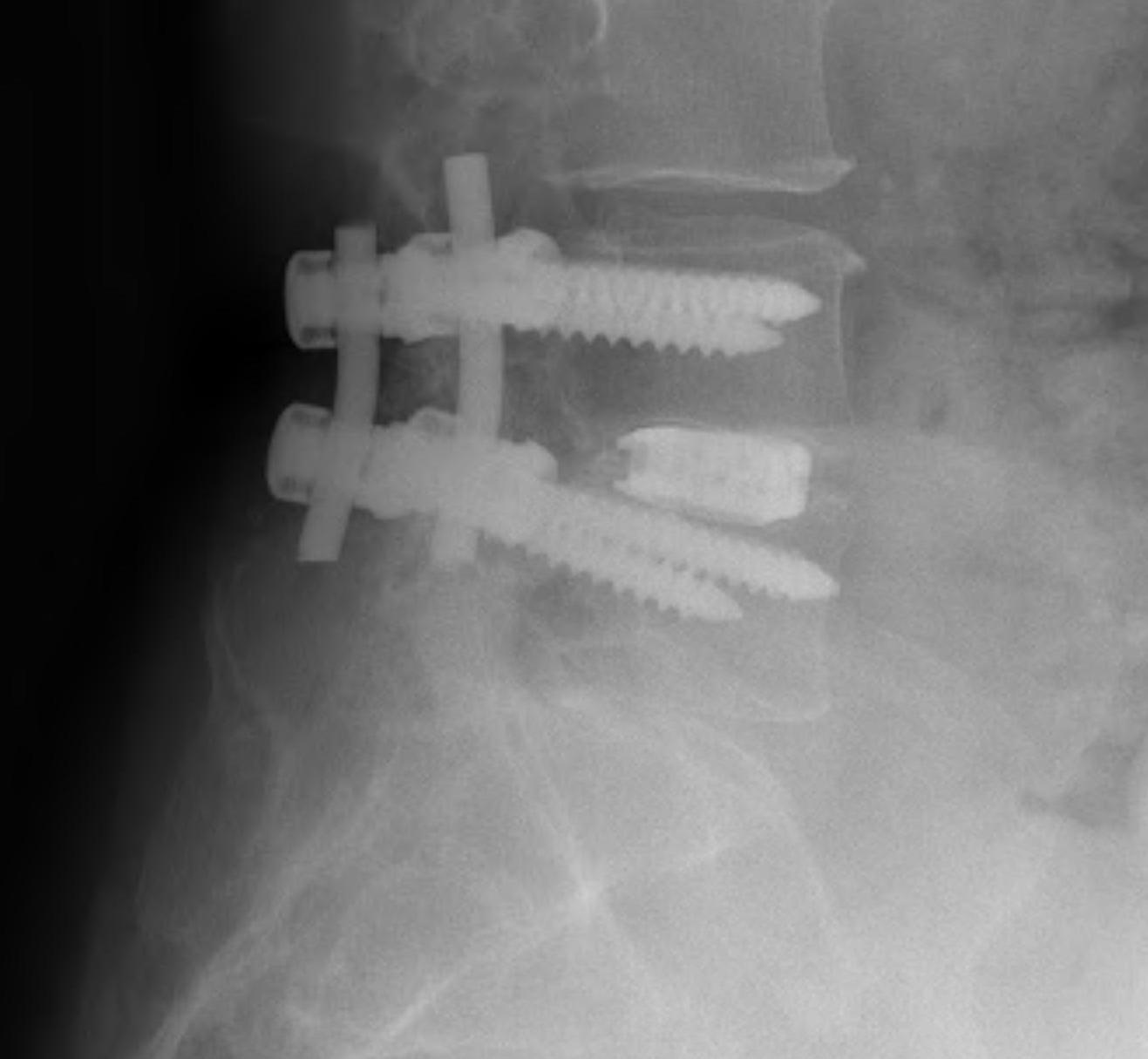 Lumbar Fusion Techniques | The Bone School