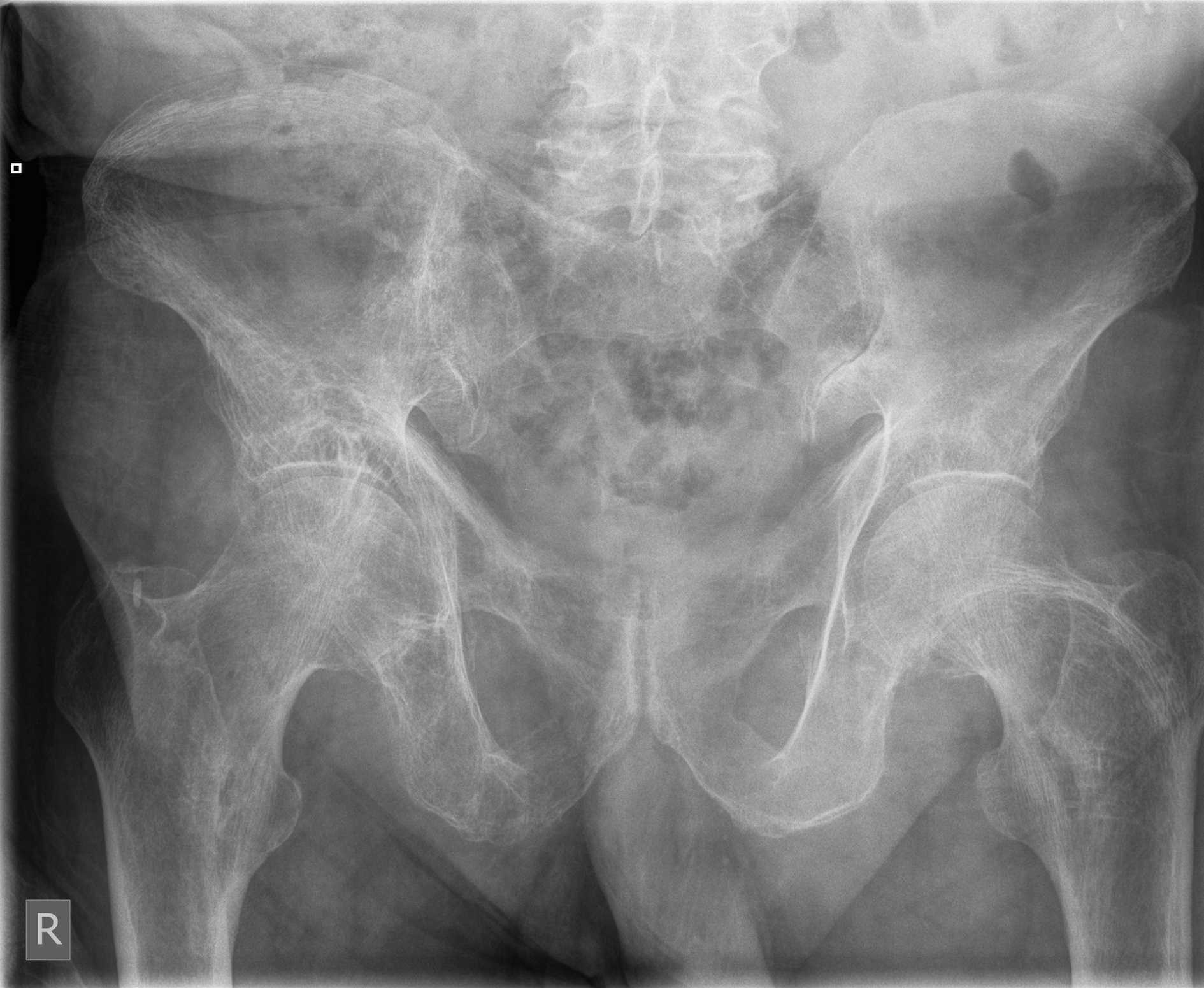 Paget's Disease | The Bone School