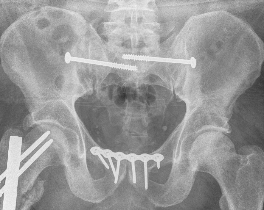 AP Compression | The Bone School