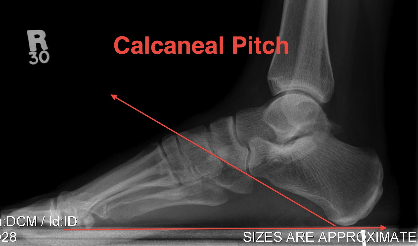Calcaneal Pitch Angle Normal at Joseph Graves blog