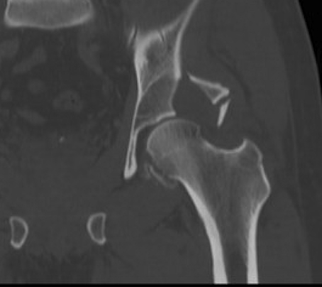 Femoral Head Fractures | The Bone School