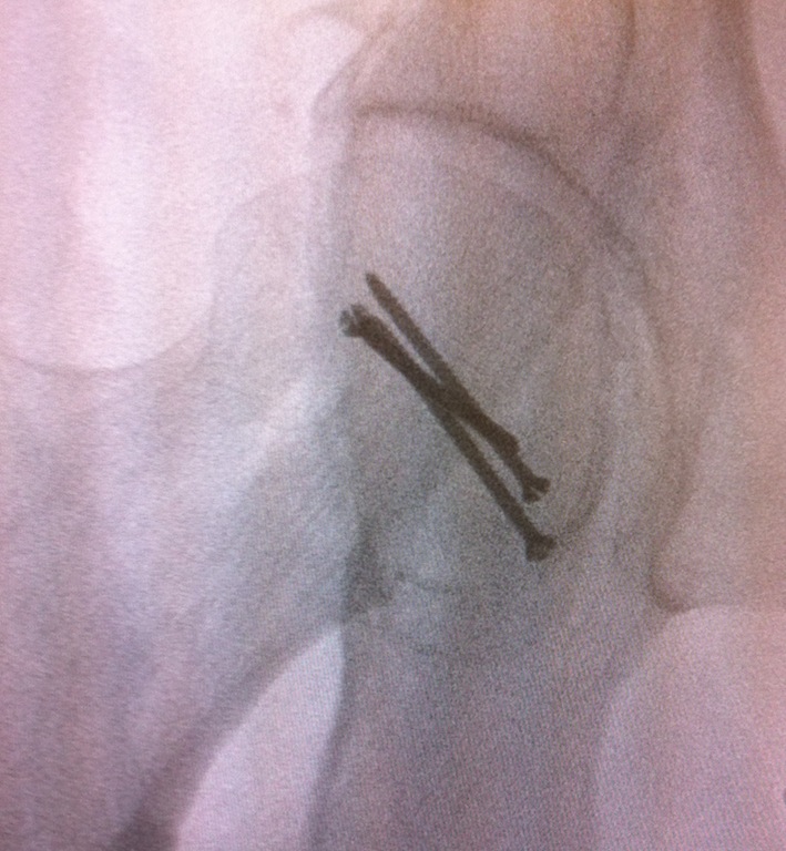 Femoral Head Fractures | The Bone School