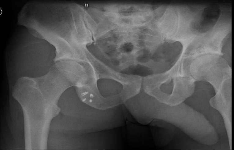 Torn Hamstring X Ray