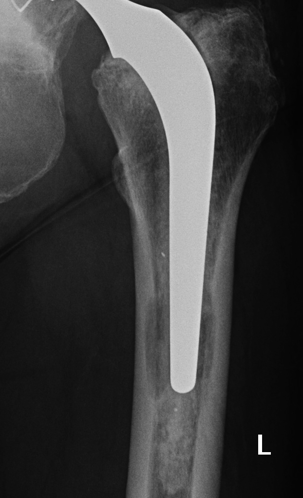 A Osteolysis and Loosening | The Bone School