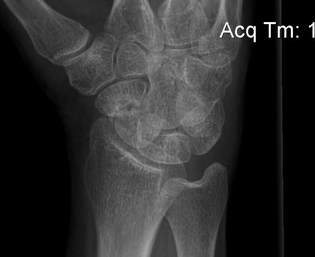 scaphoid | The Bone School