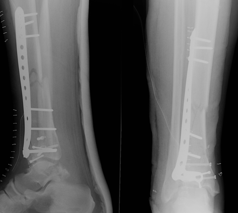 Tibial Plafond | The Bone School