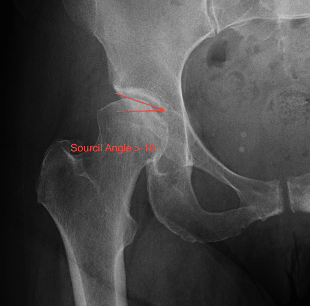 Acetabular Dysplasia | The Bone School