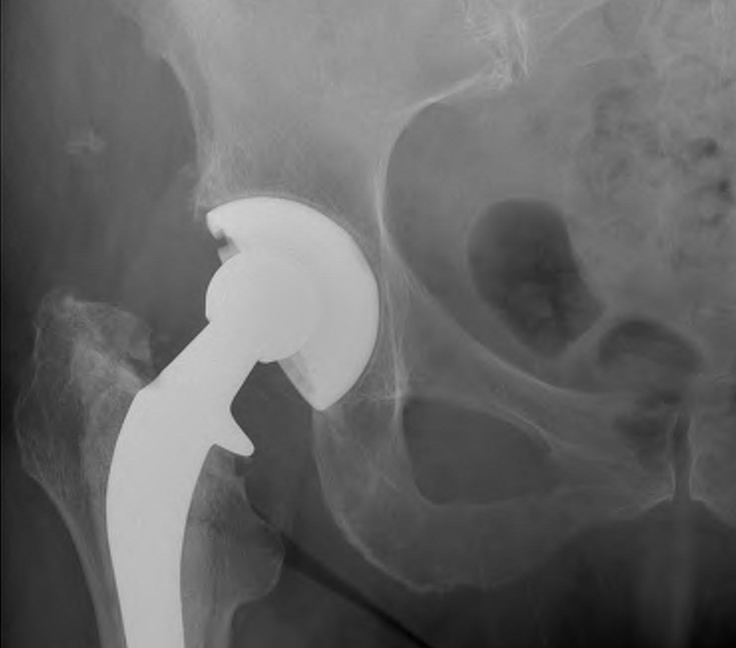 A Osteolysis and Loosening | The Bone School
