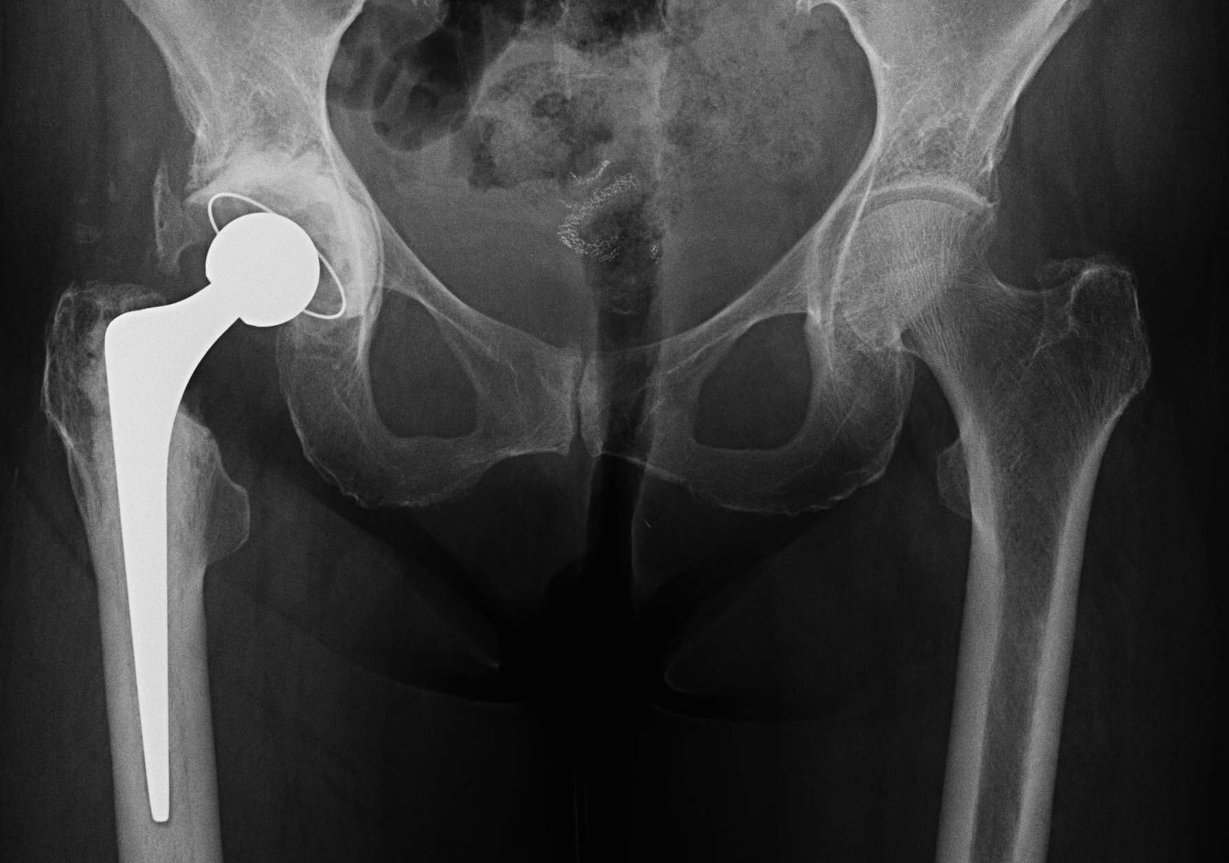 True Leg Length Discrepancy Test