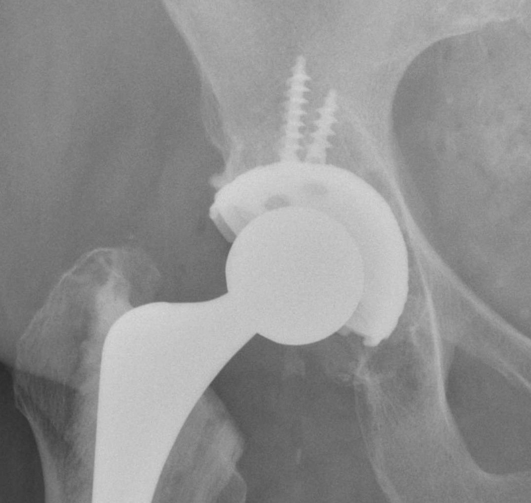 screw fixation | The Bone School