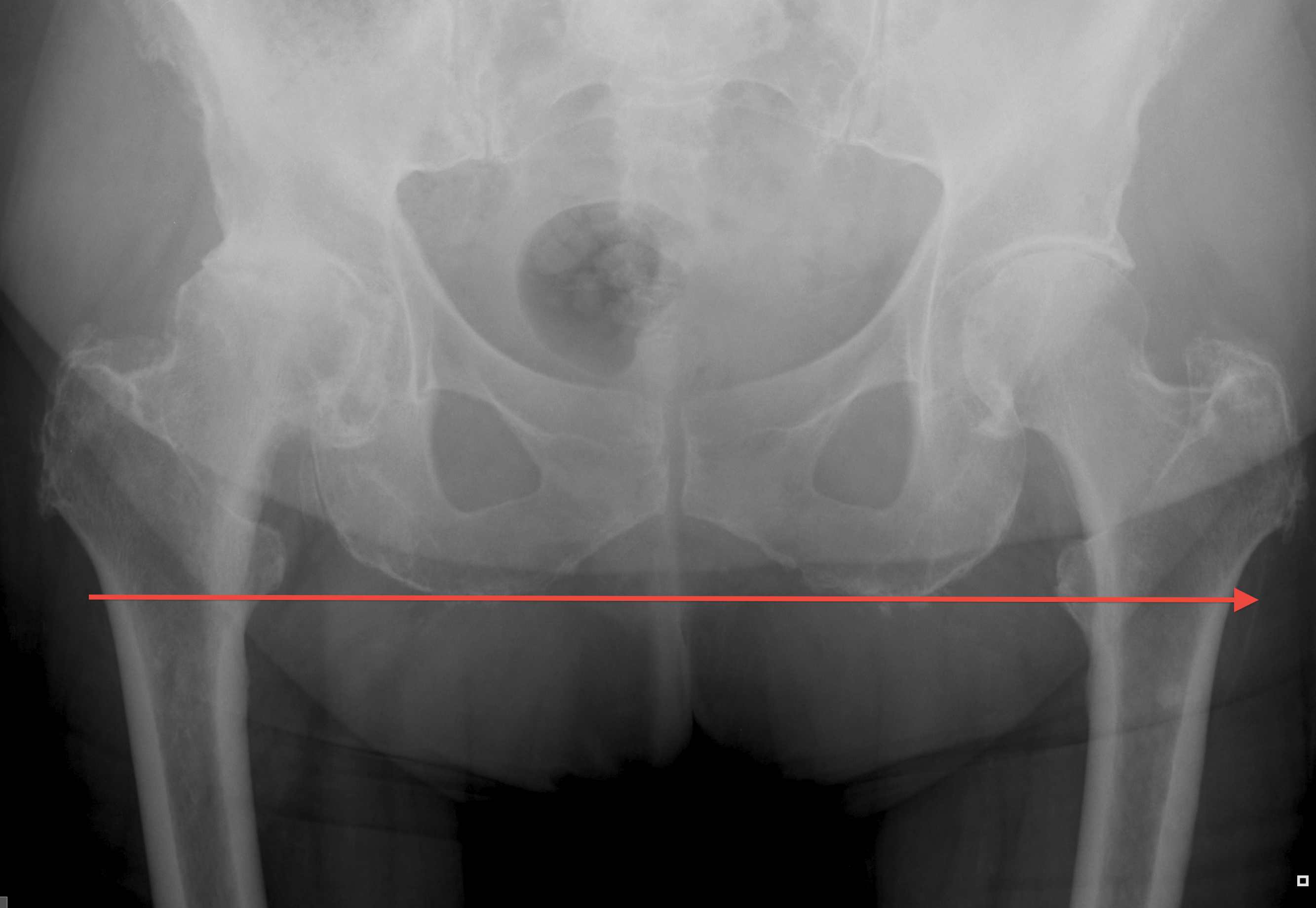 Leg Length Discrepancy | The Bone School