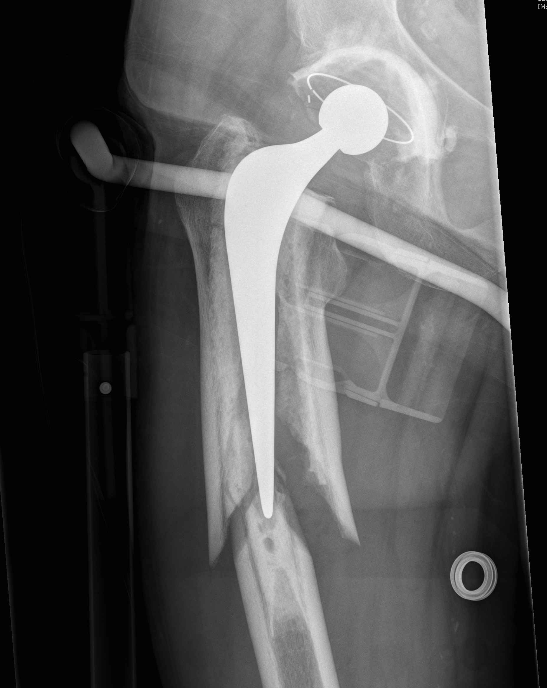 Periprosthetic Fracture | The Bone School