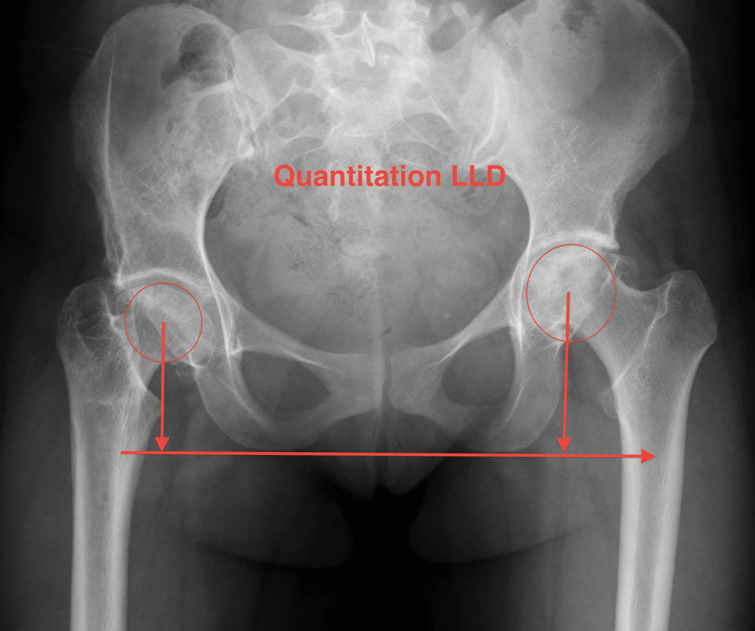 Leg Length Discrepancy | The Bone School