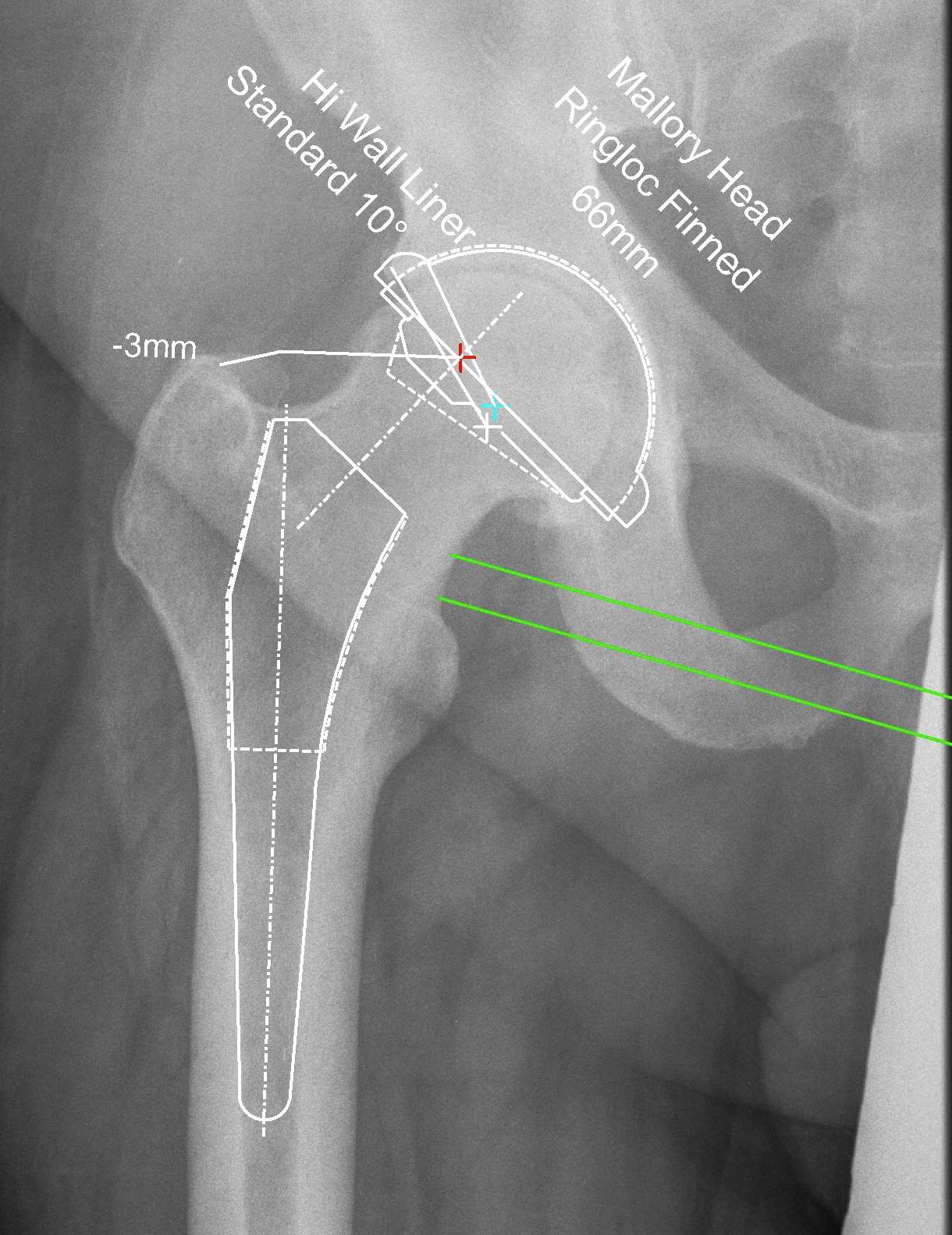 total hip arthroplasty | The Bone School