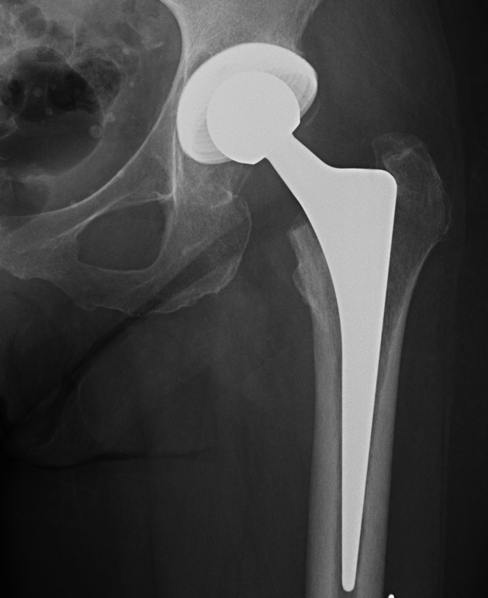 Dorr Classification | The Bone School