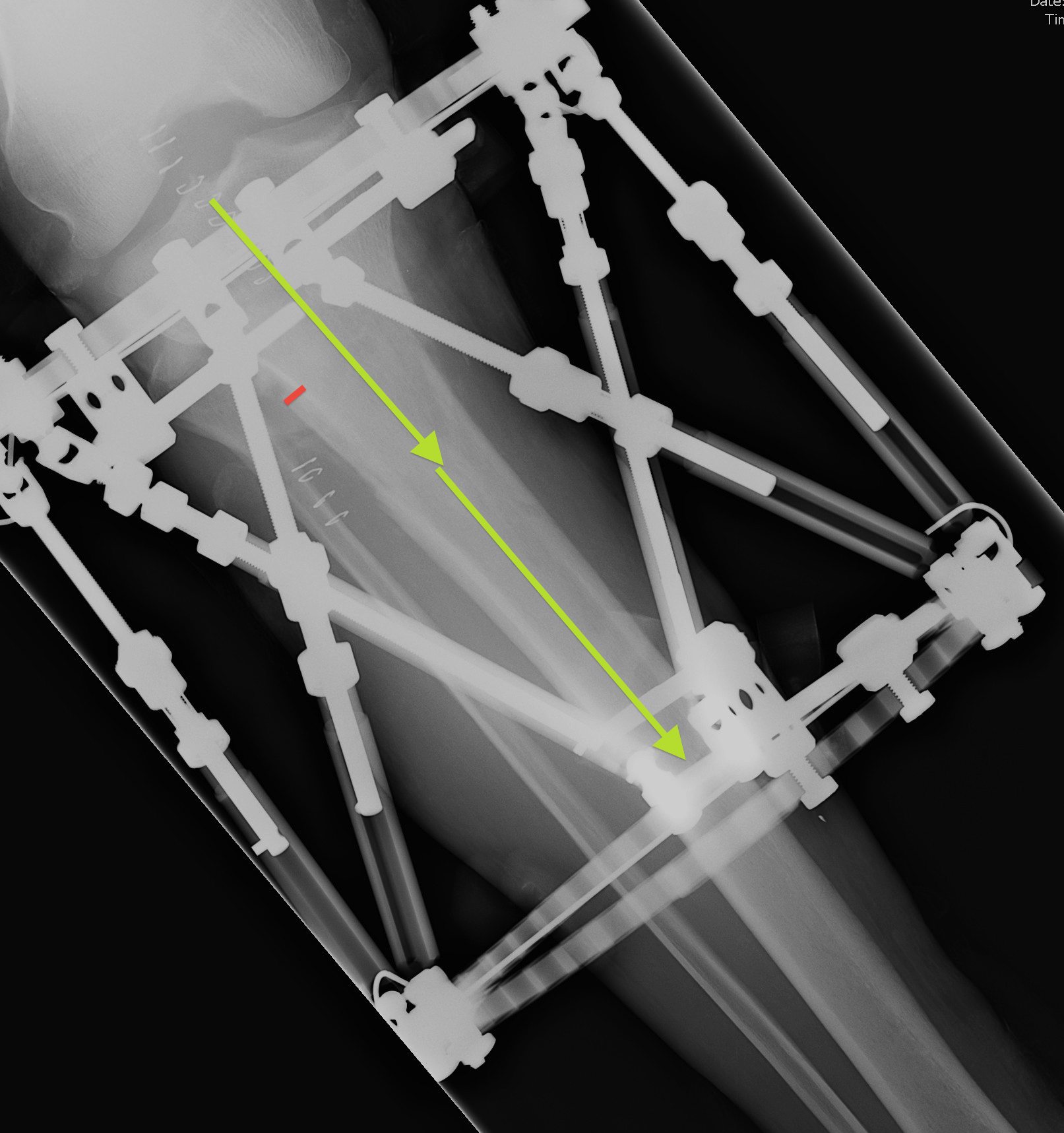 Taylor Spatial Frame | The Bone School