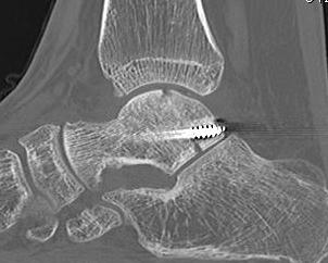 Talar body fracture | The Bone School