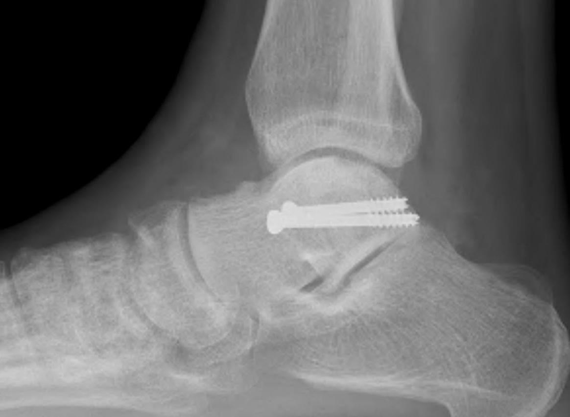 Talar body fracture | The Bone School