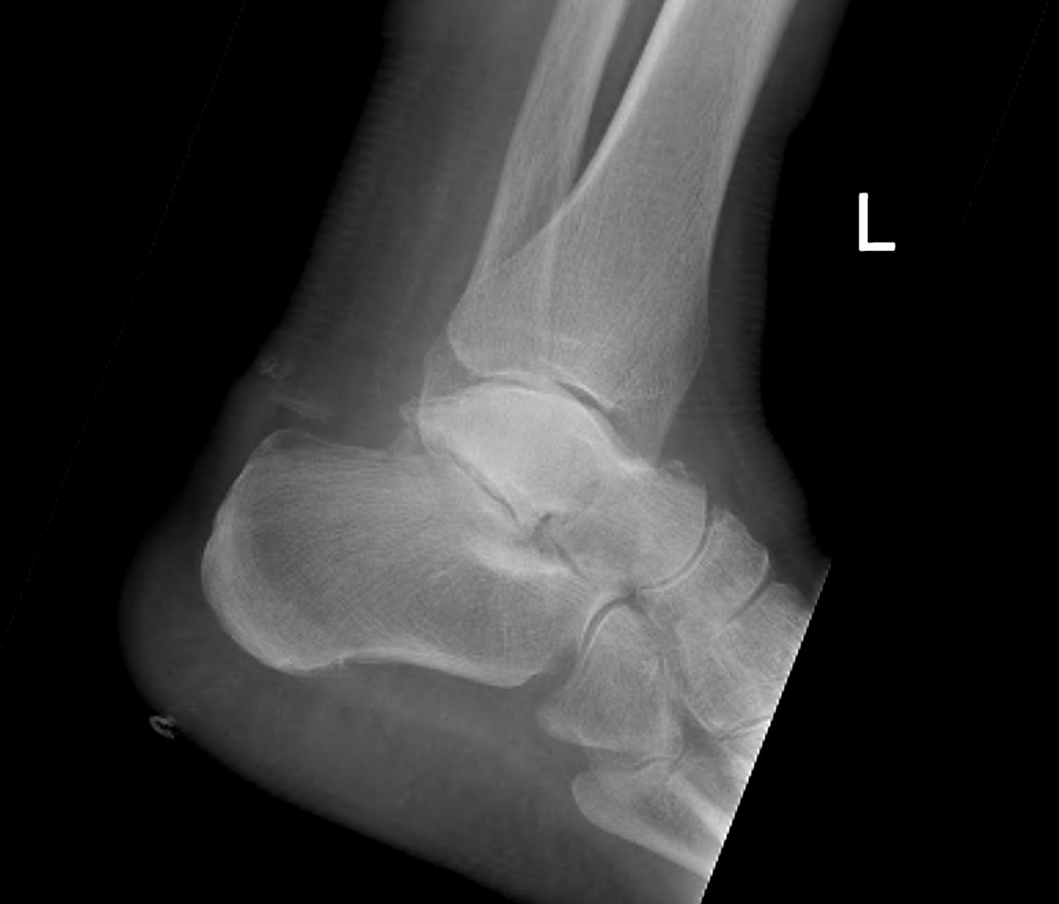 Talar Neck Complications | The Bone School