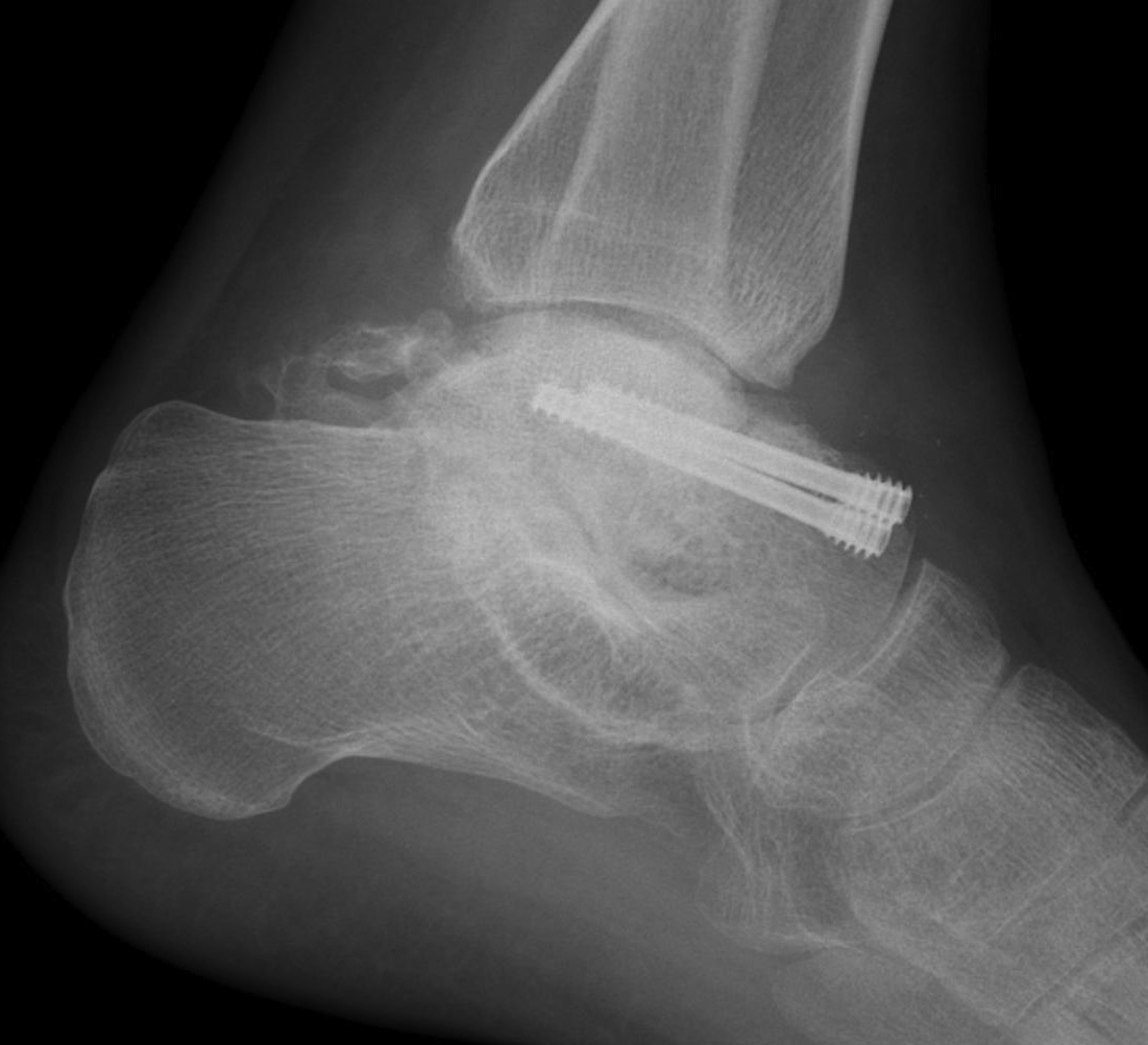 Talar neck complications | The Bone School