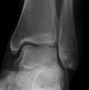 Pain after Lateral Ankle Sprain | The Bone School