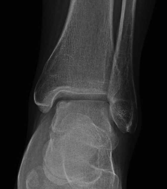 Osteochondral lesions and JOCD | The Bone School