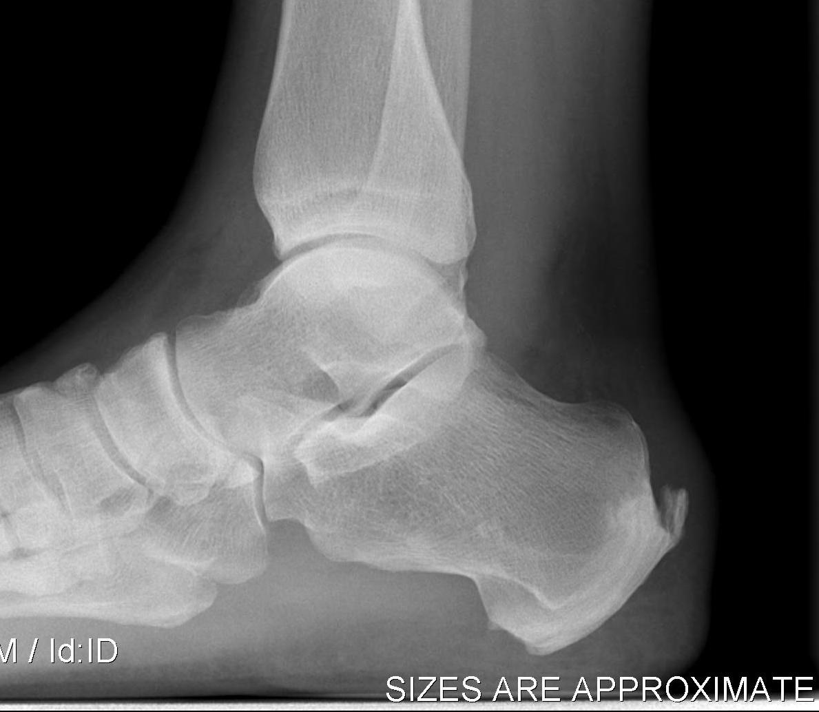 Achilles Tendonopathy | The Bone School