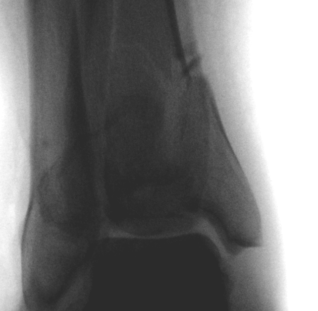 Tibial Plafond / Pilon | The Bone School