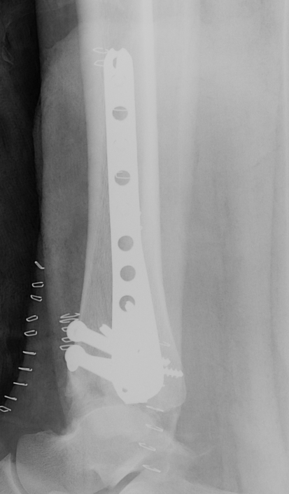 Tibial Plafond / Pilon | The Bone School